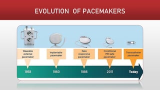 PACEMAKER | PPT