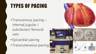 pacemaker.pdf