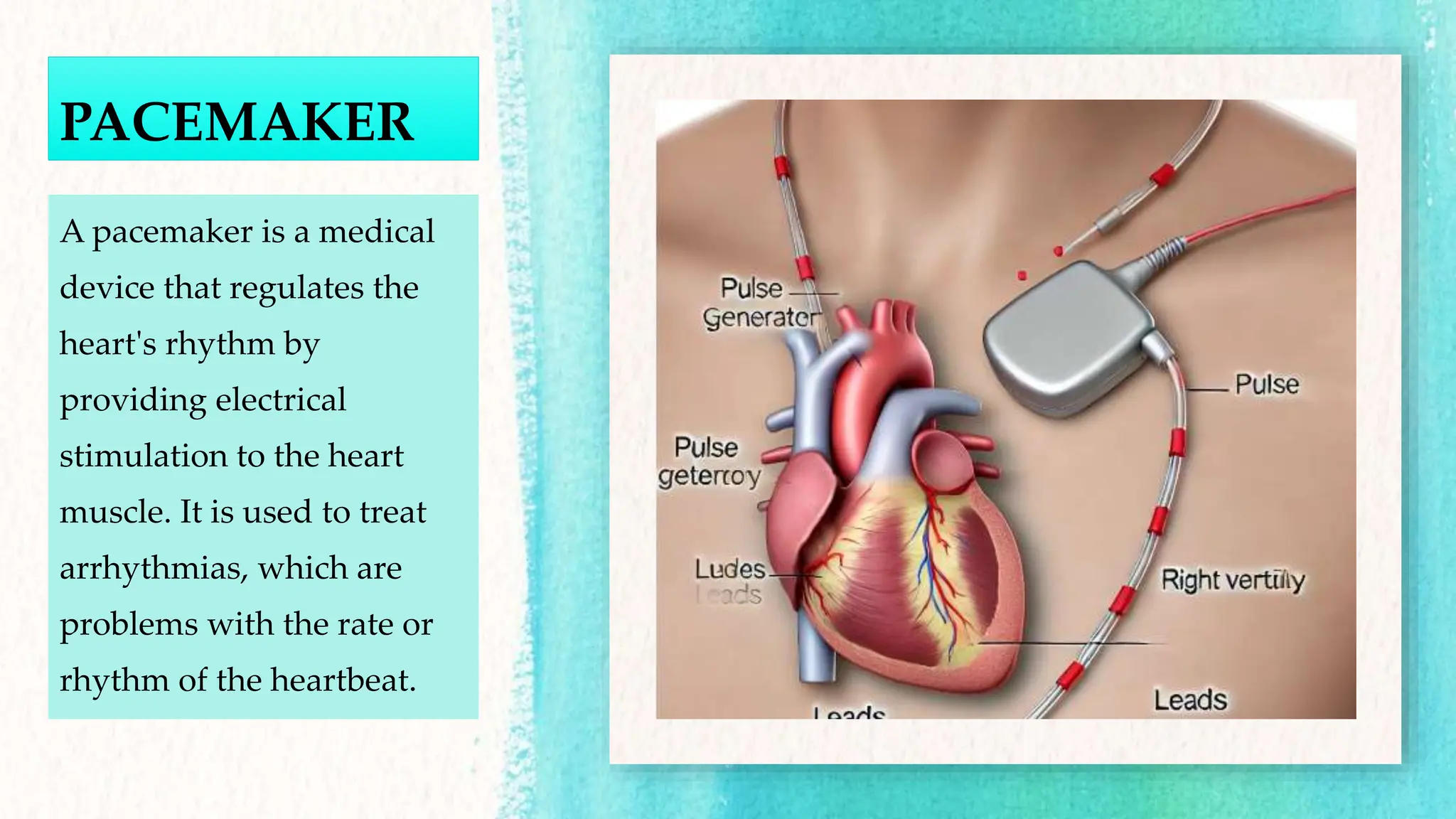 Pacemaker.pptx