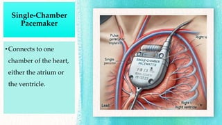 Pacemaker.pptx