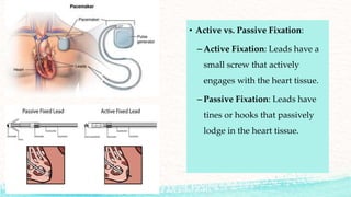 Pacemaker.pptx