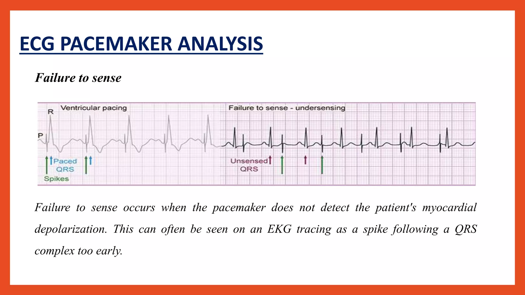 Pacemaker | PPTX