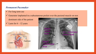 Pacemaker | PPTX