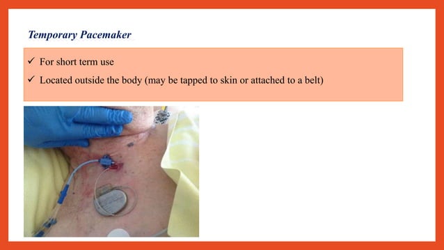 Pacemaker | PPTX | Heart and Cardiovascular Diseases | Diseases and ...