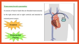 Pacemaker | PPTX