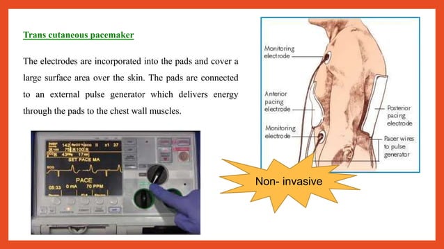 Pacemaker | PPTX | Heart and Cardiovascular Diseases | Diseases and ...