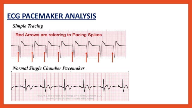Pacemaker | PPTX | Heart and Cardiovascular Diseases | Diseases and ...