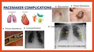Pacemaker | PPTX
