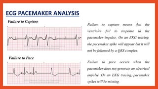 Pacemaker Failure To Capture