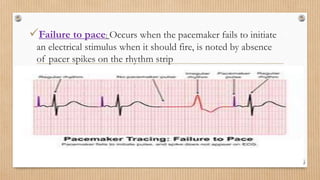 Pacemaker | PPT