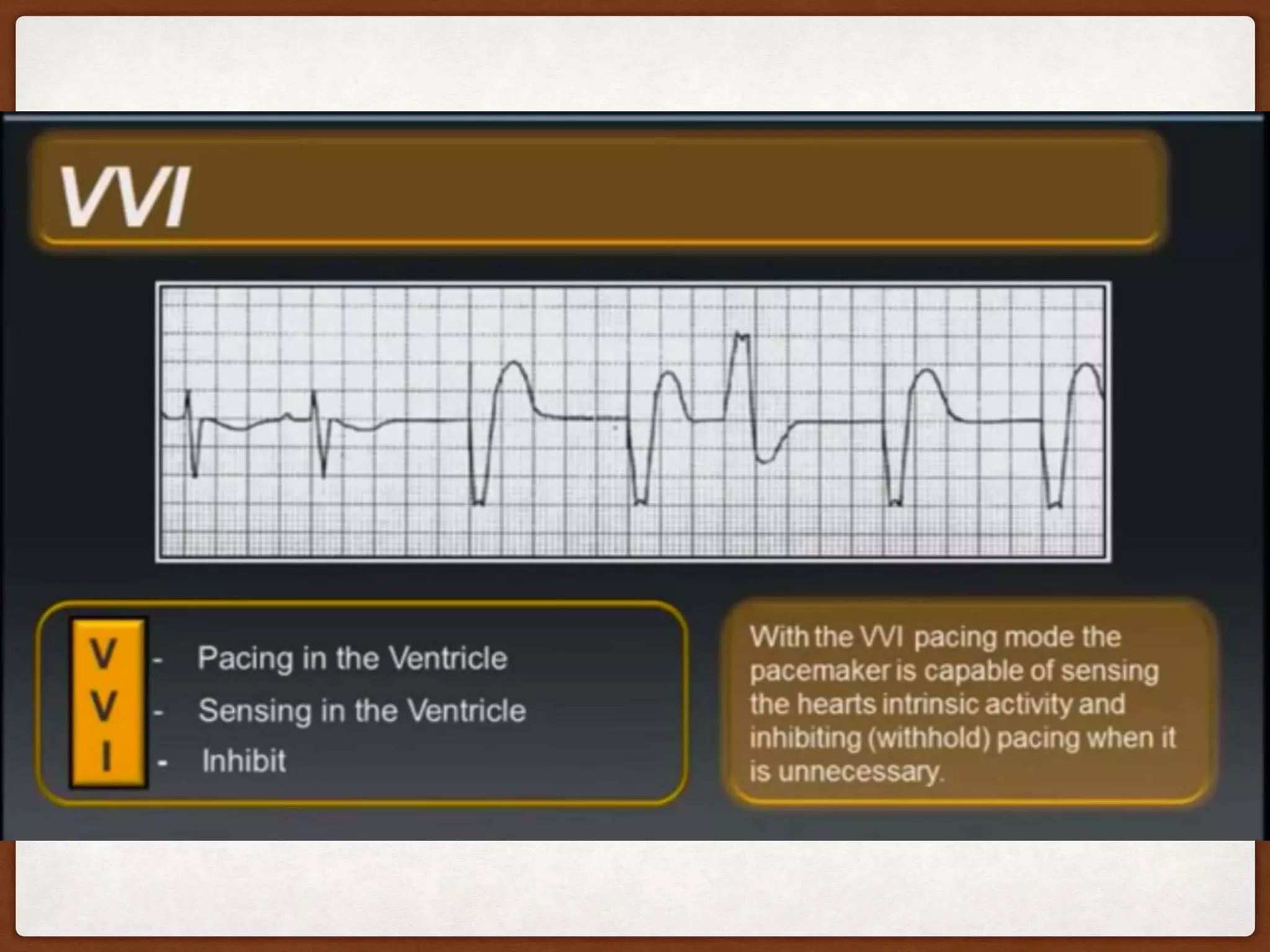 Cardiac Pacemakers - Basics | PPTX
