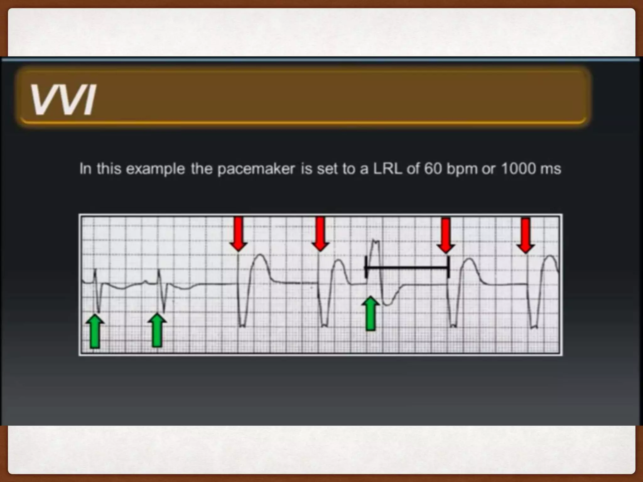 Cardiac Pacemakers - Basics | PPTX