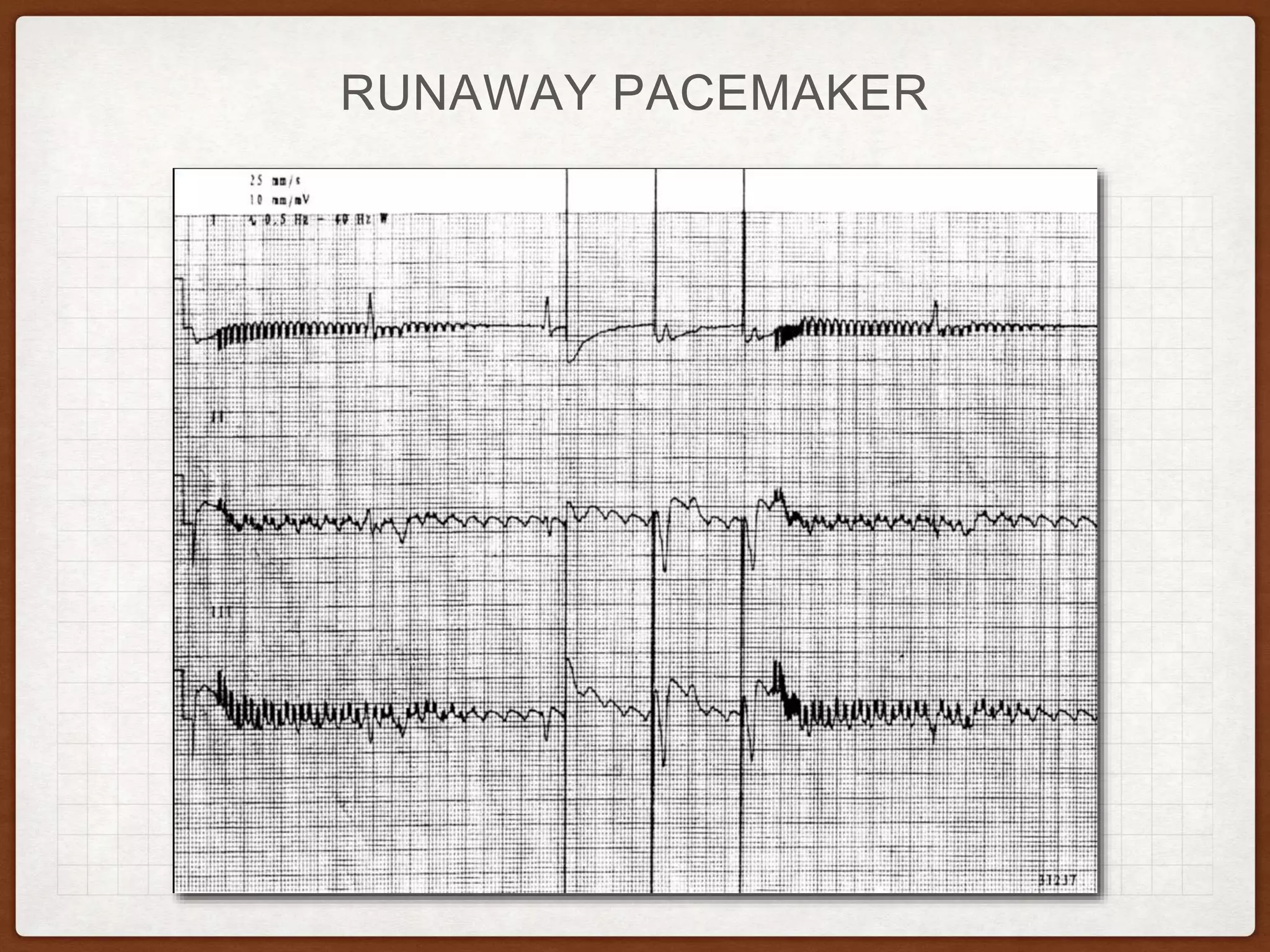 Cardiac Pacemakers - Basics | PPTX