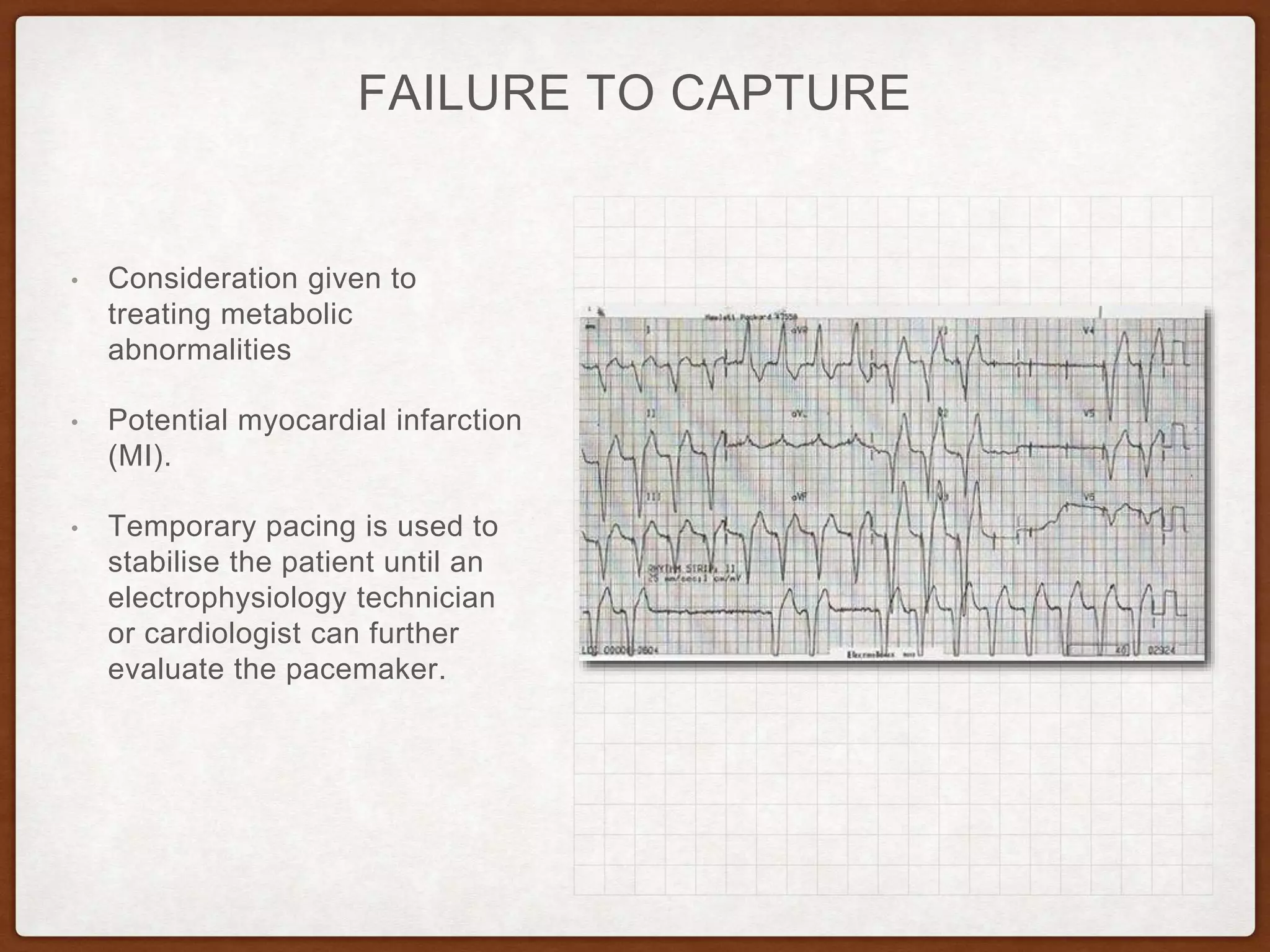 Cardiac Pacemakers - Basics | PPTX