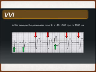 Cardiac Pacemakers - Basics | PPTX