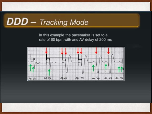 Cardiac Pacemakers - Basics | PPTX | Heart and Cardiovascular Diseases ...