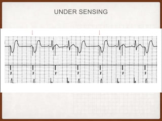 Cardiac Pacemakers - Basics | PPTX