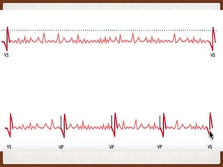 Cardiac Pacemakers - Basics | PPTX | Heart and Cardiovascular Diseases ...