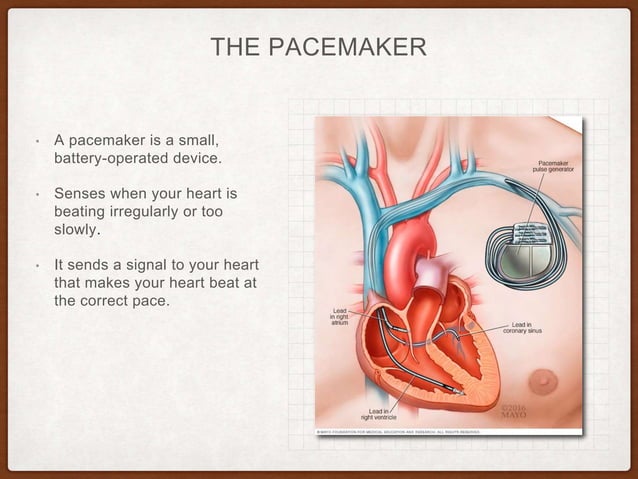 Cardiac Pacemakers - Basics | PPTX | Heart and Cardiovascular Diseases | Diseases and Conditions