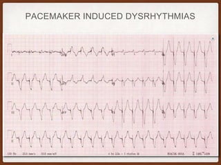 Cardiac Pacemakers - Basics | PPTX