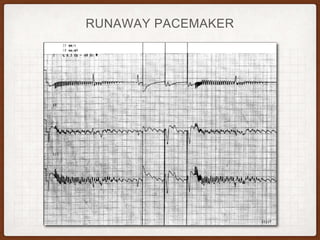 Cardiac Pacemakers - Basics | PPTX