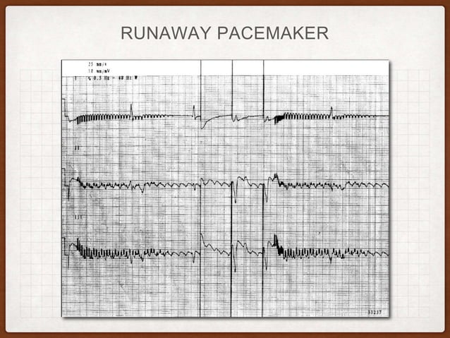 Cardiac Pacemakers - Basics | PPTX | Heart and Cardiovascular Diseases ...
