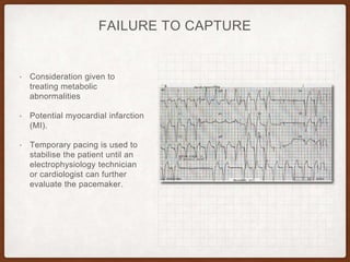Cardiac Pacemakers - Basics | PPTX