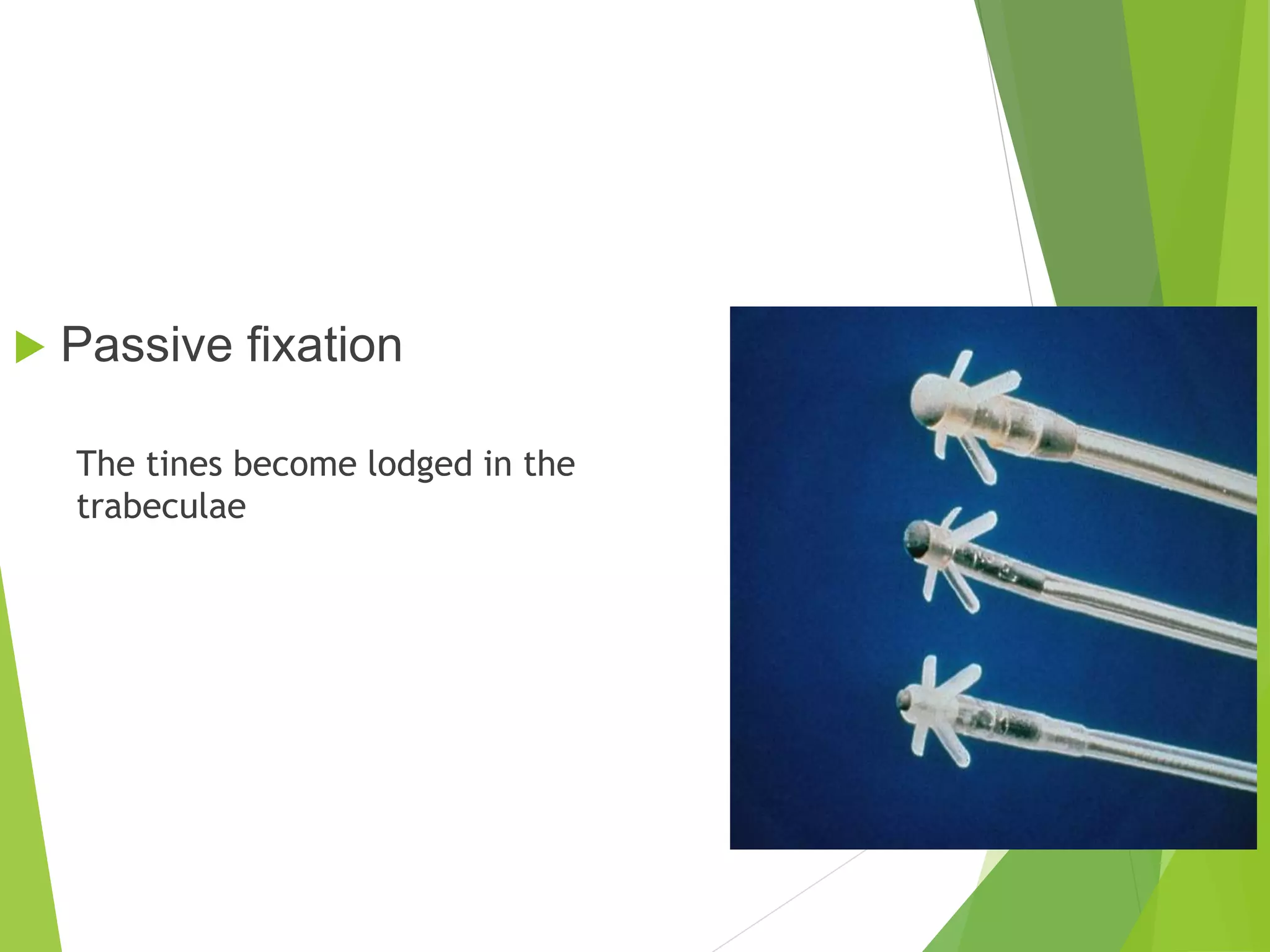 PACEMAKER BASIC AND TIMING CYCLE .pptx | Heart and Cardiovascular ...