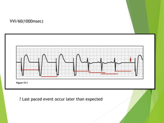 PACEMAKER BASIC AND TIMING CYCLE .pptx