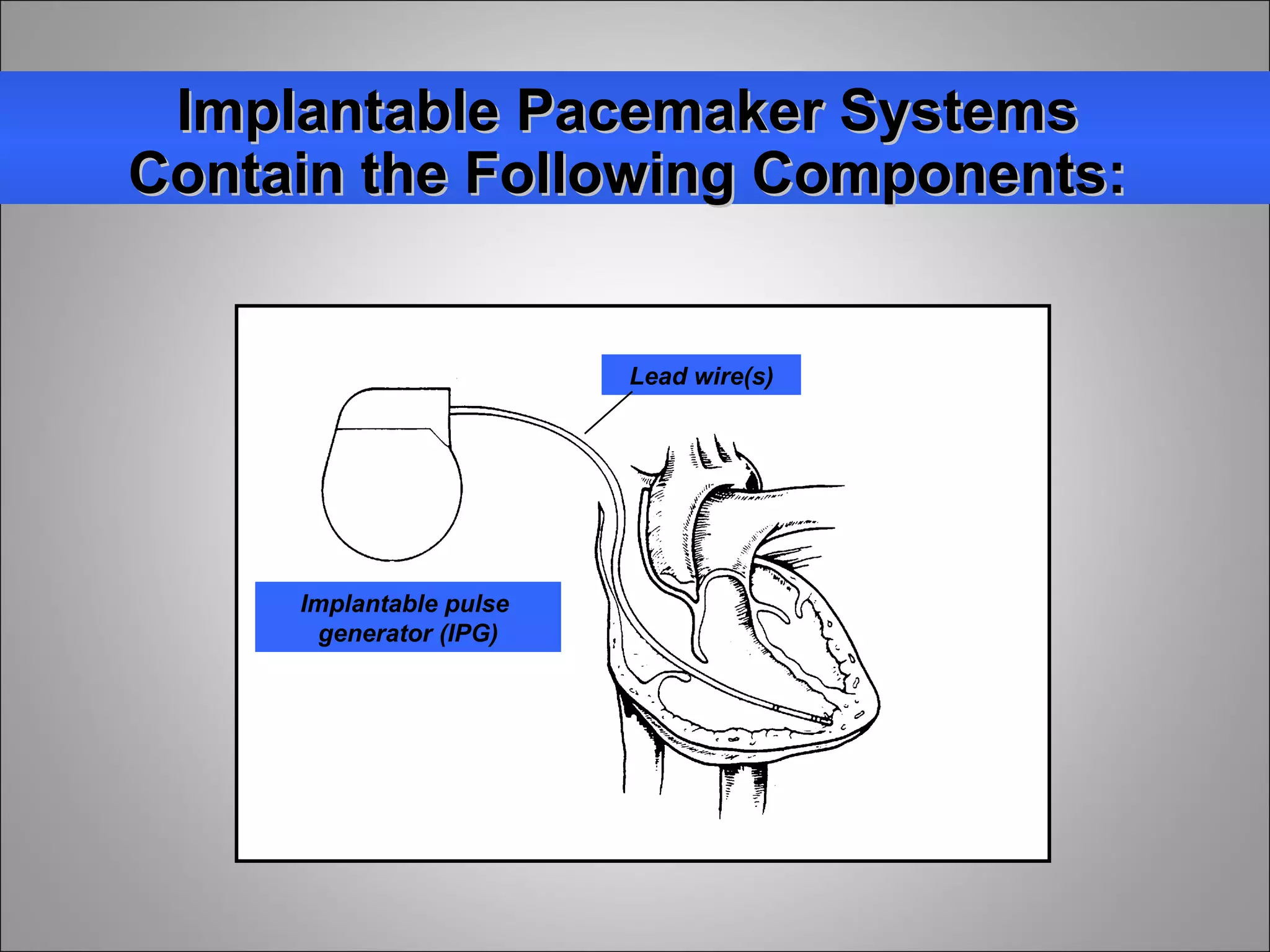 Pacemaker basics | PPT