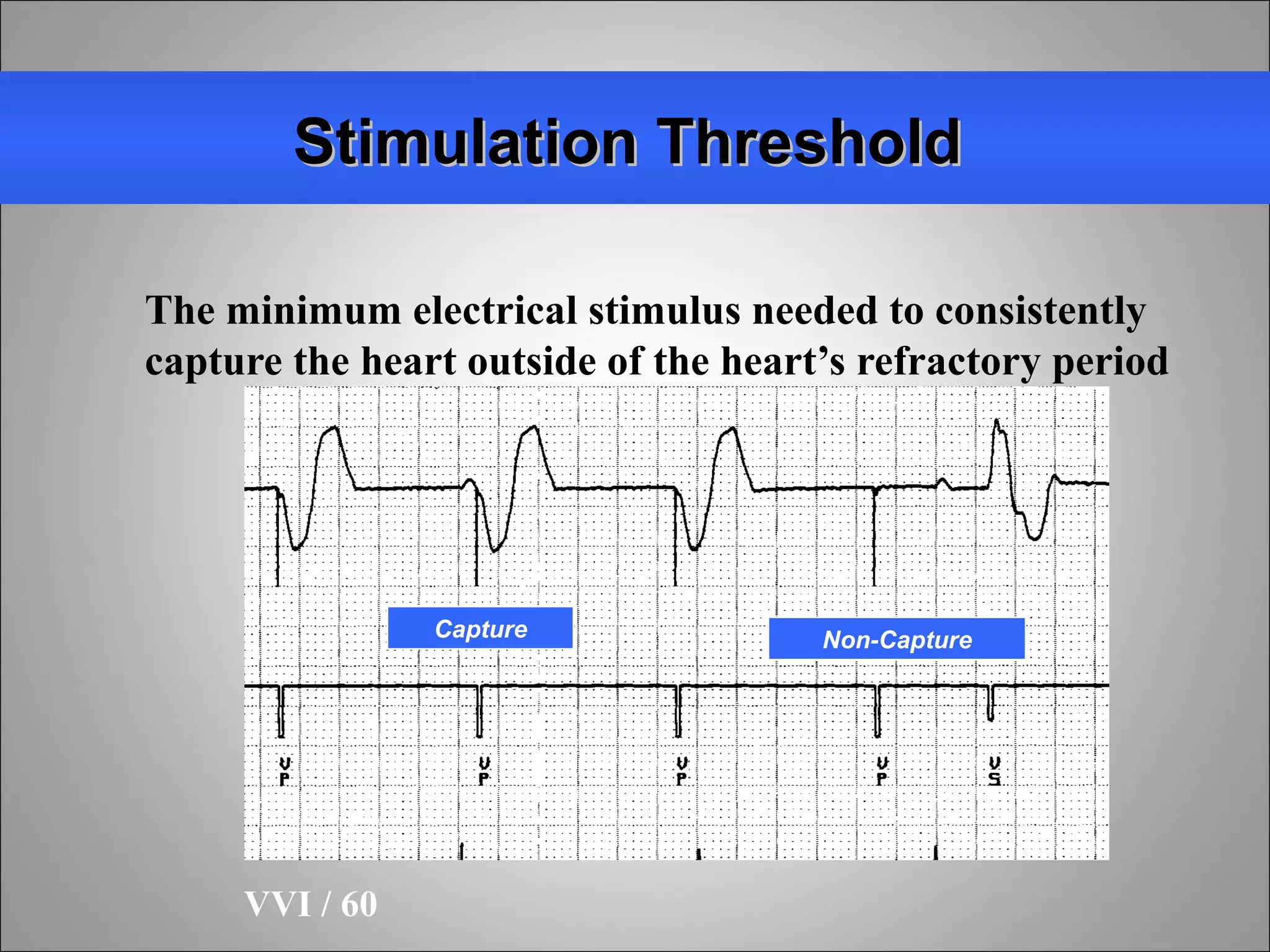 Pacemaker basics | PPT