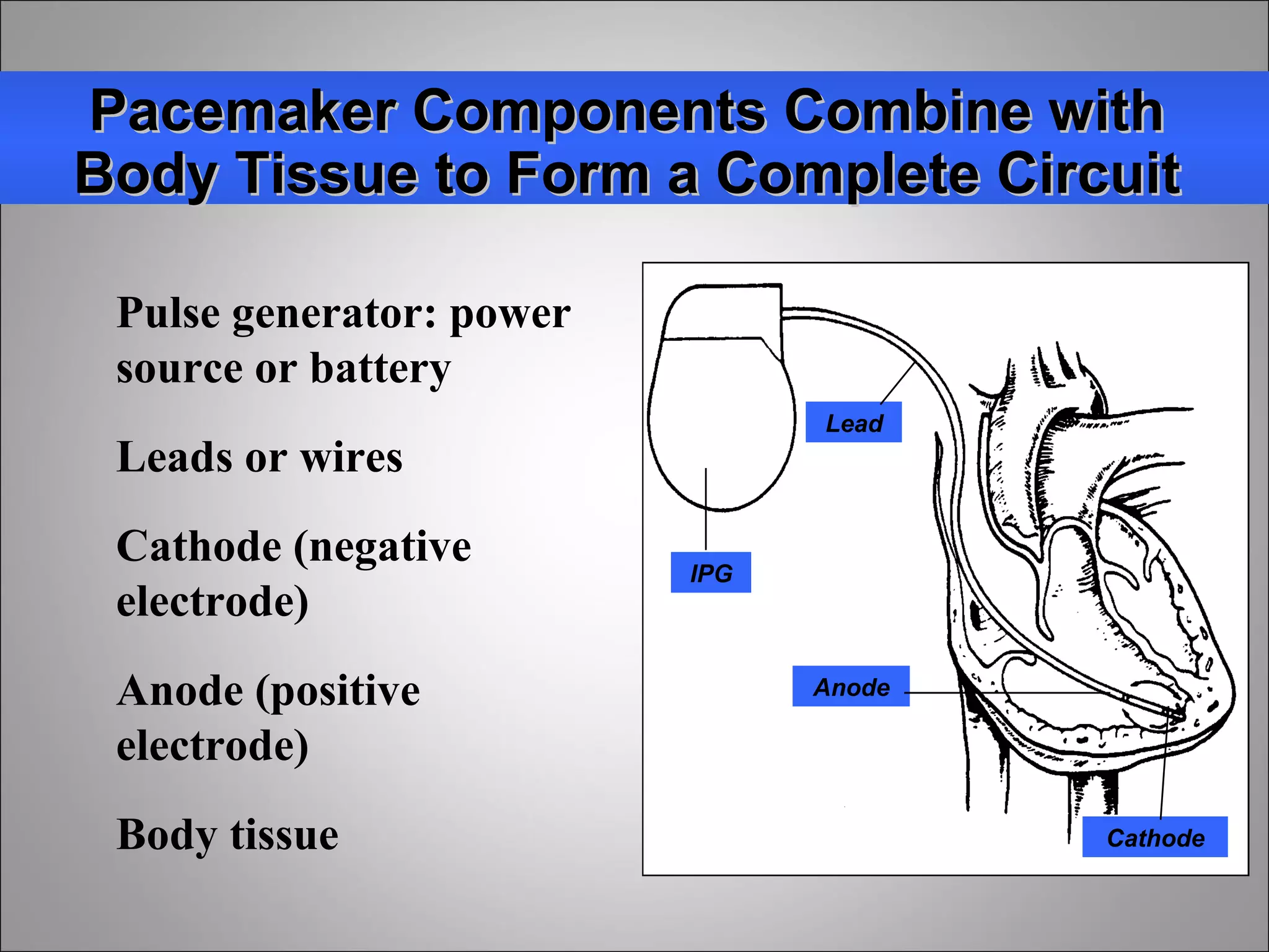Pacemaker basics | PPT