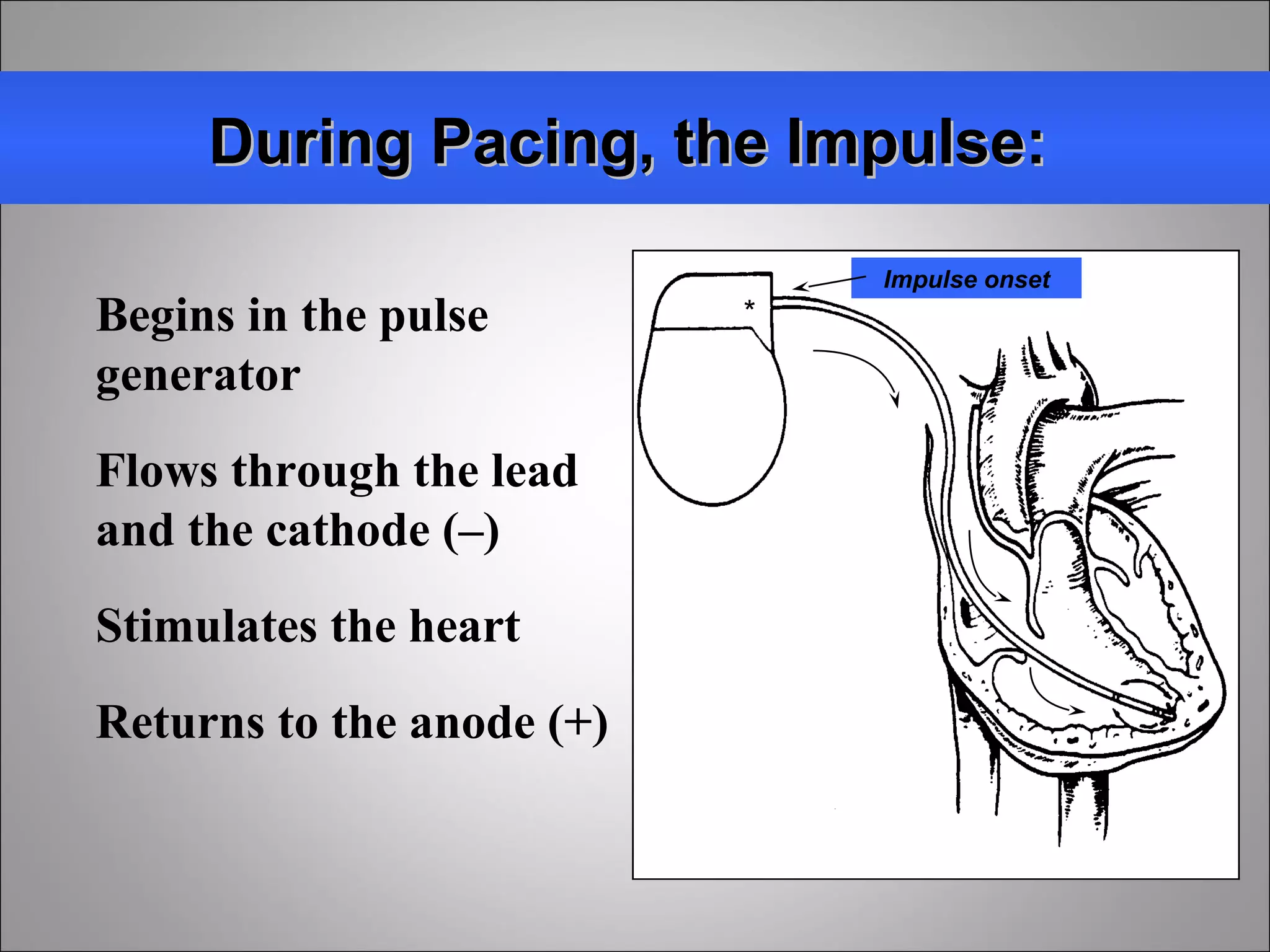 Pacemaker basics | PPT