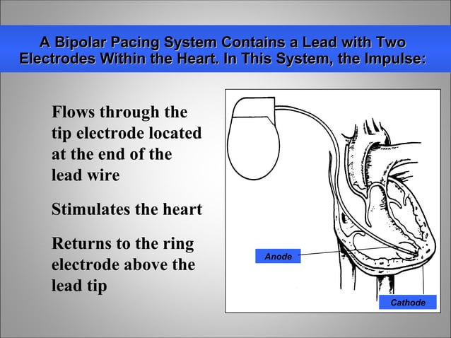 Pacemaker basics | PPT