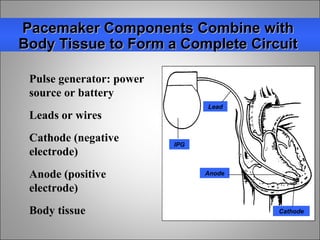Pacemaker basics | PPT