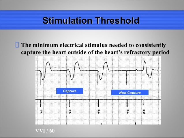 Pacemaker basics
