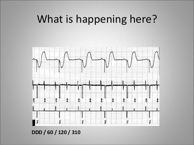 Pacemaker basics