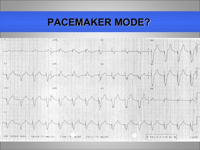 Pacemaker basics