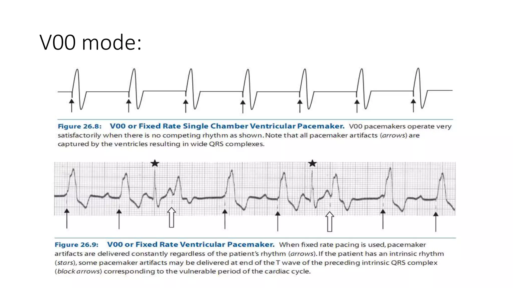 Pacemaker ecg | PPTX