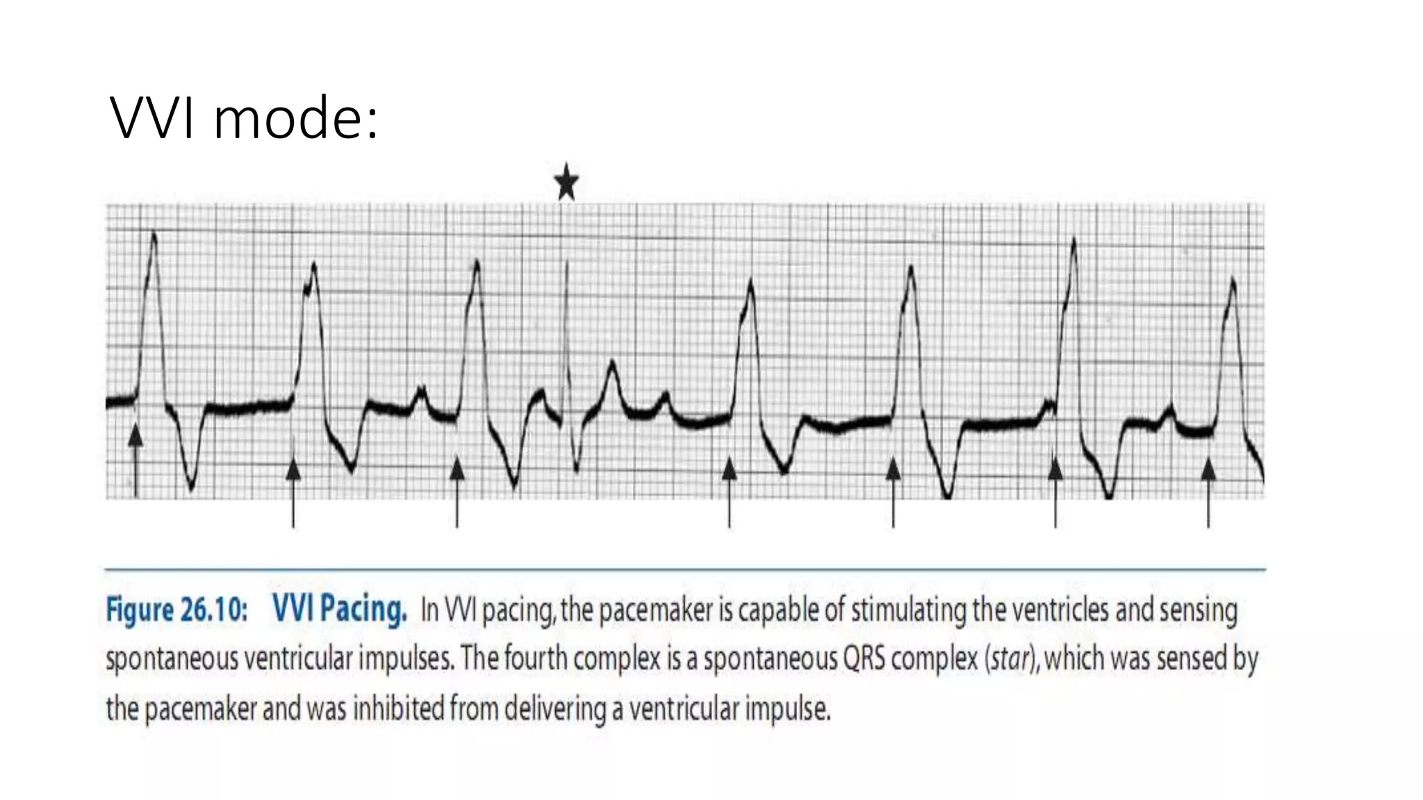 Pacemaker ecg | PPTX