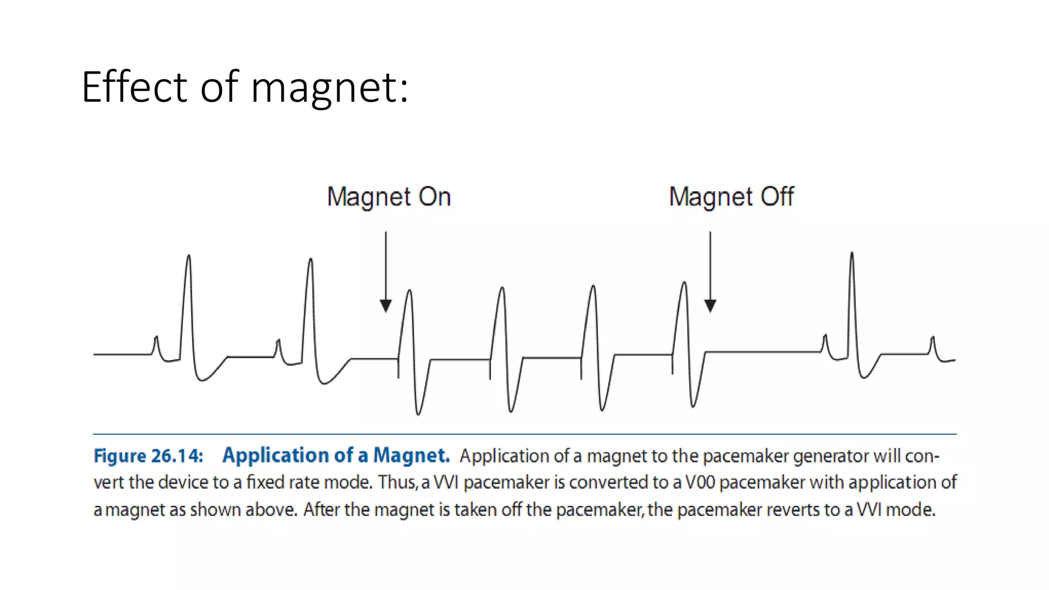 Pacemaker ecg | PPTX