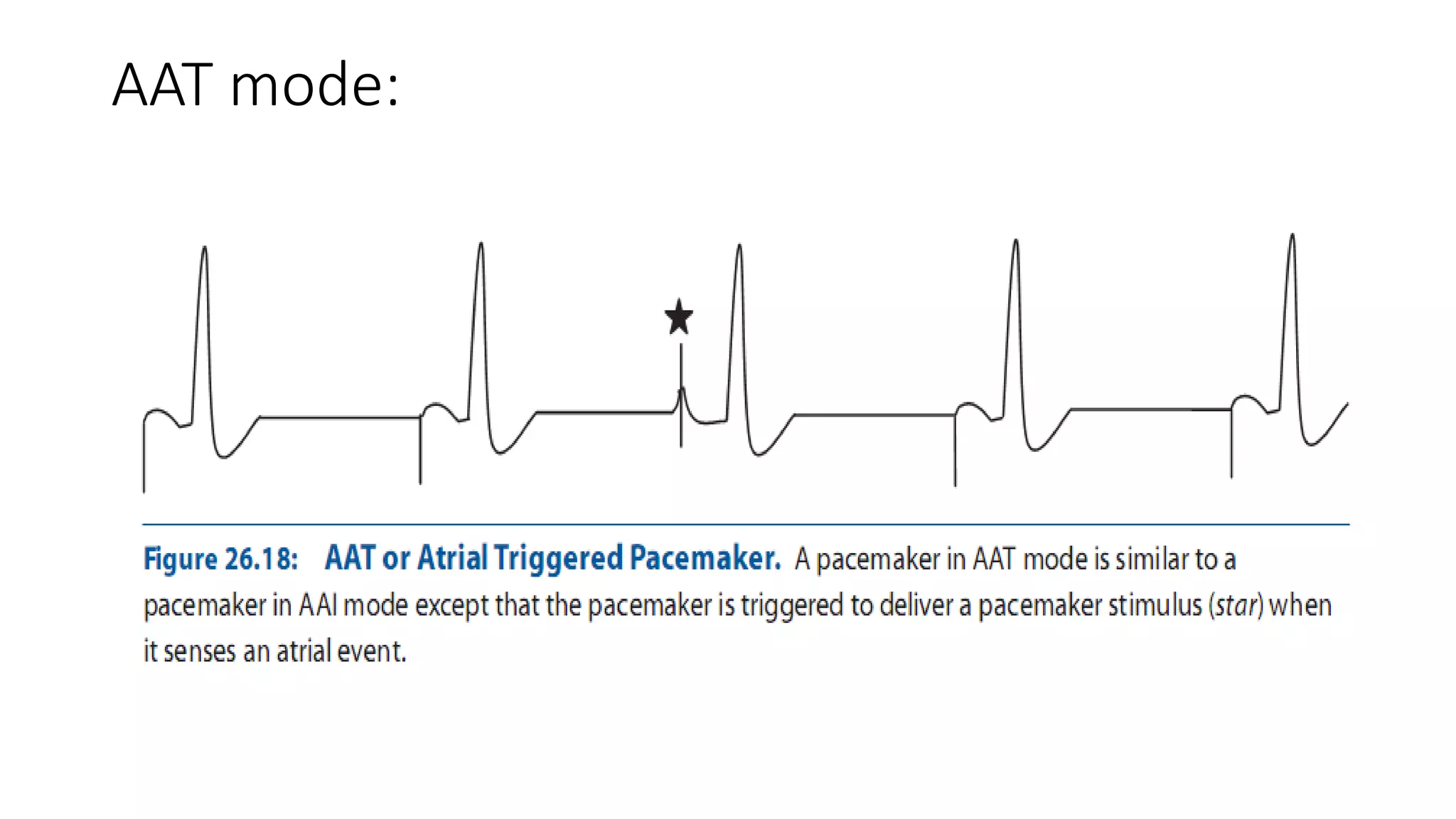 Pacemaker ecg | PPTX