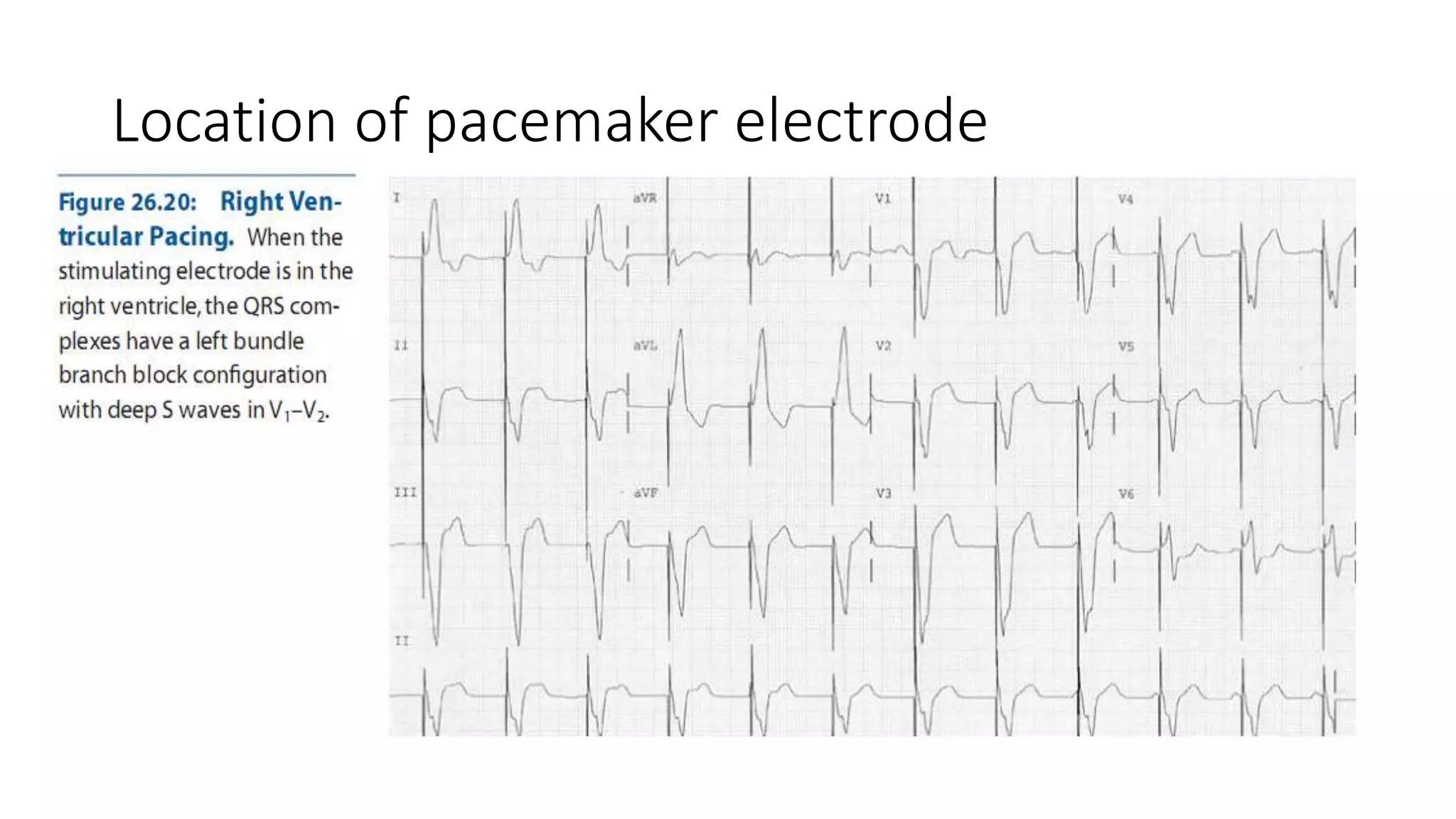 Pacemaker ecg | PPTX
