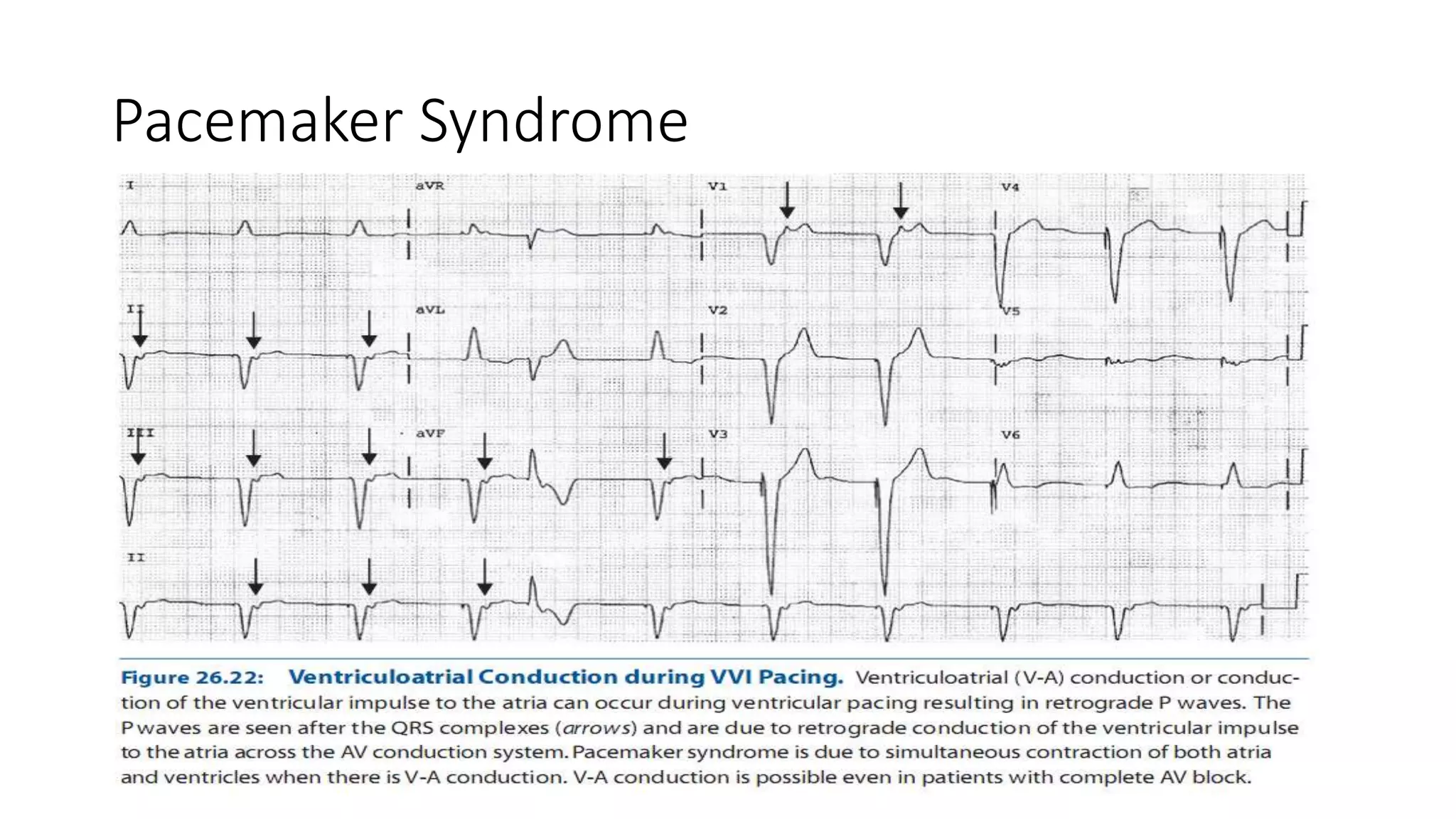 Pacemaker ecg | PPTX