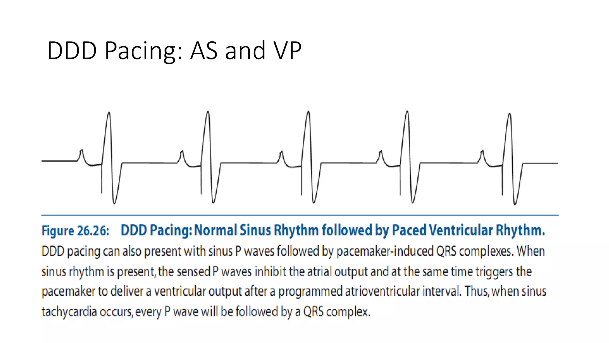 Pacemaker ecg | PPTX