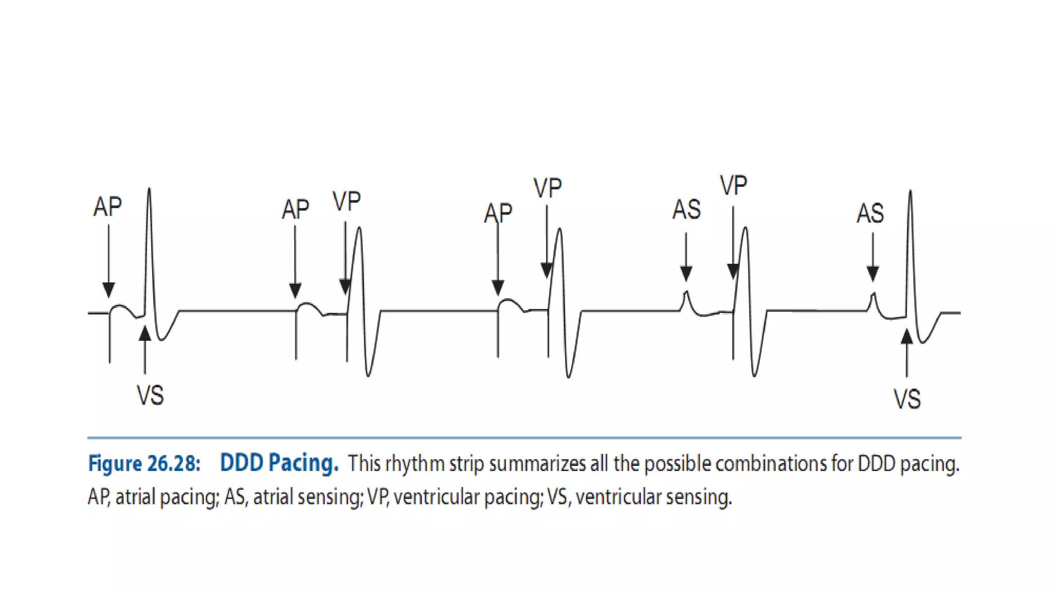 Pacemaker ecg | PPTX