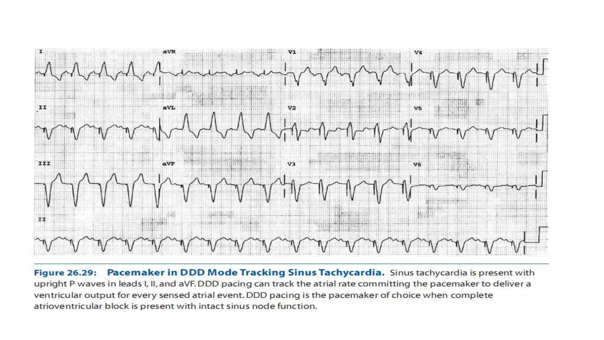 Pacemaker ecg | PPTX