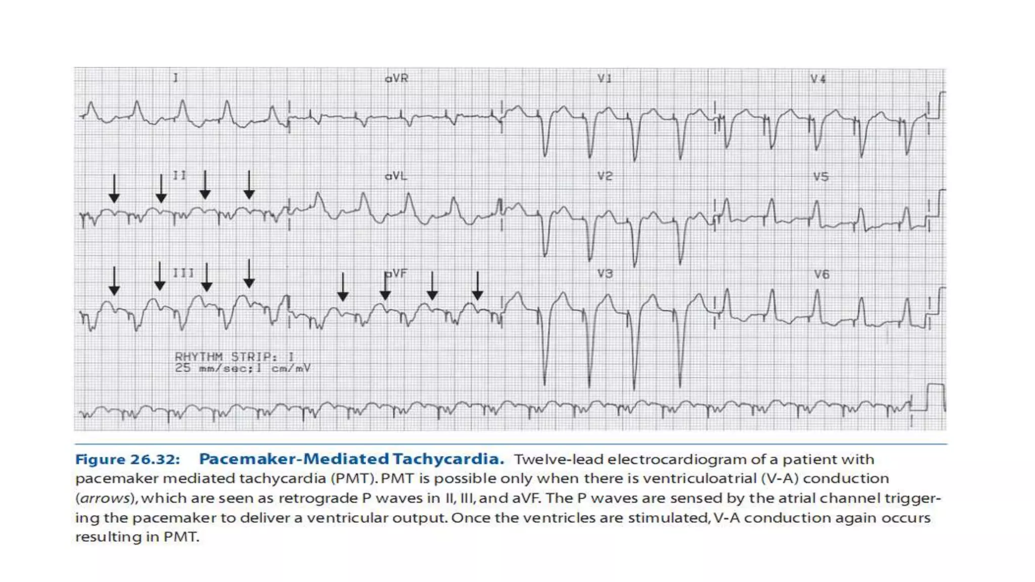 Pacemaker ecg | PPTX