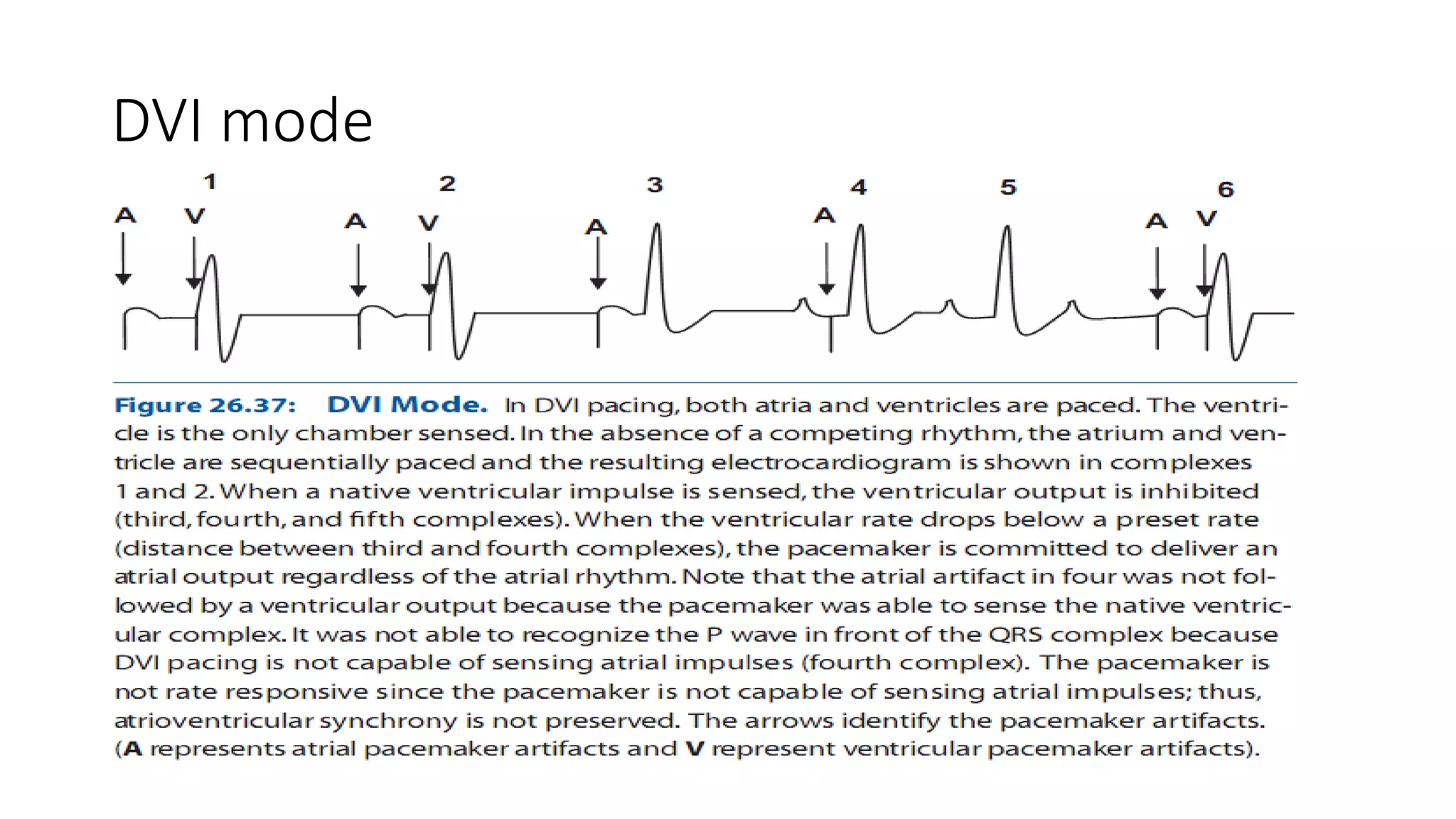 Pacemaker ecg | PPTX