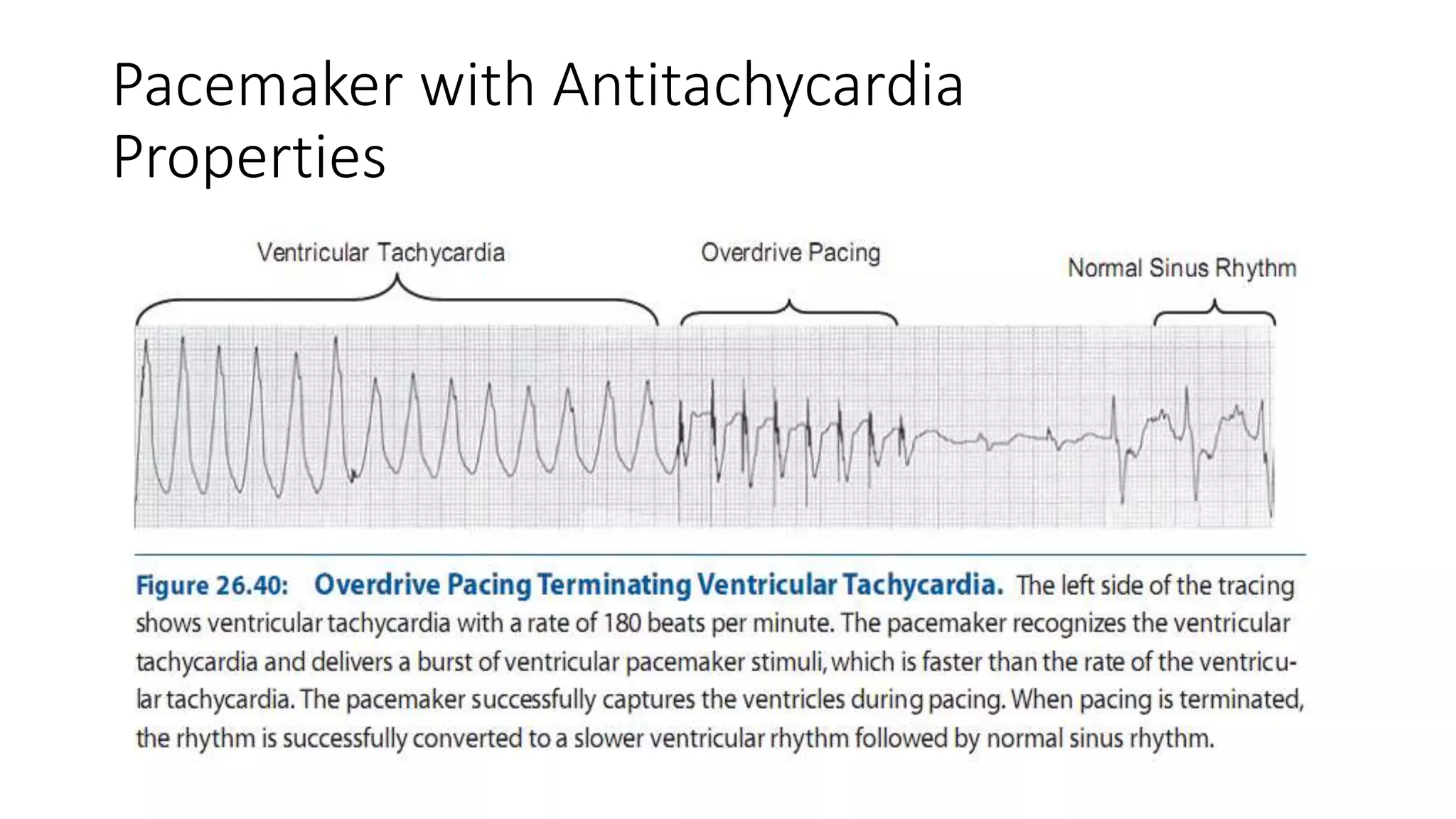 Pacemaker ecg | PPTX